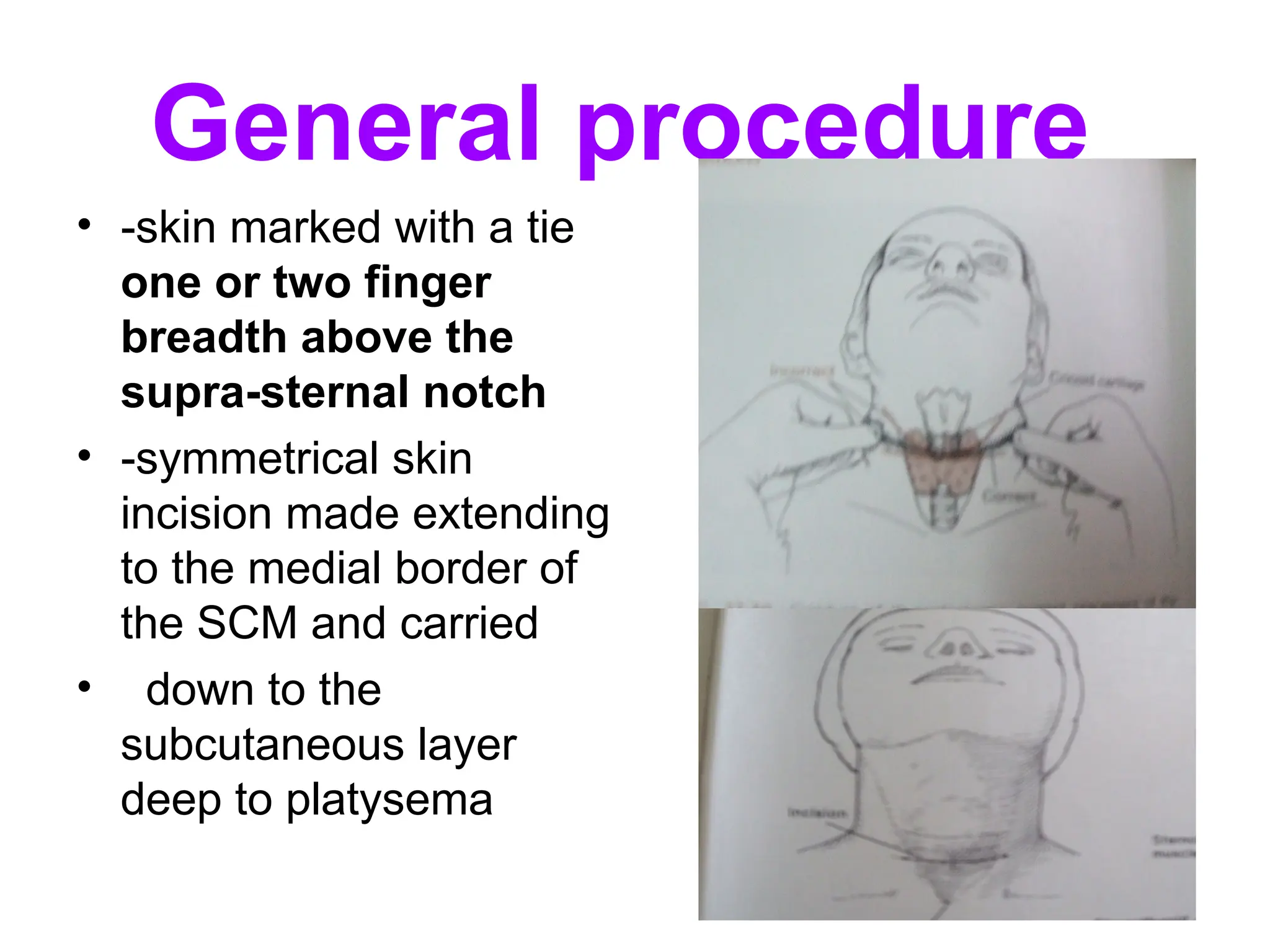 Techniques of Thyroidectomy.pptTechniques of Thyroidectomy.ppt | Free ...