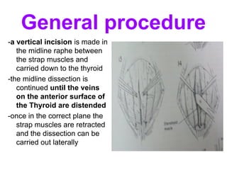 Techniques of Thyroidectomy.pptTechniques of Thyroidectomy.ppt