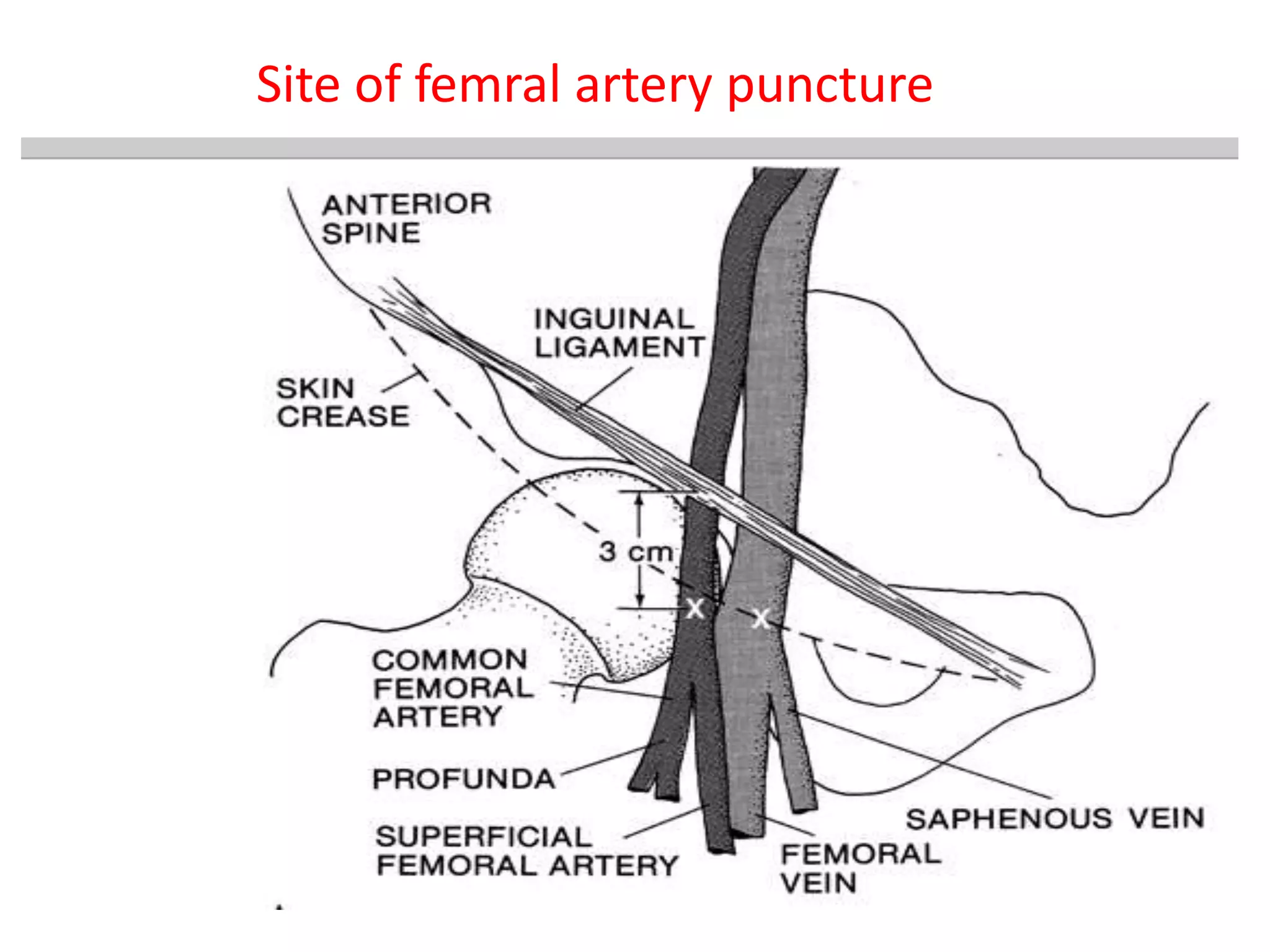Techniques of Vascular acess for Cardiac Catheterization | PPSX