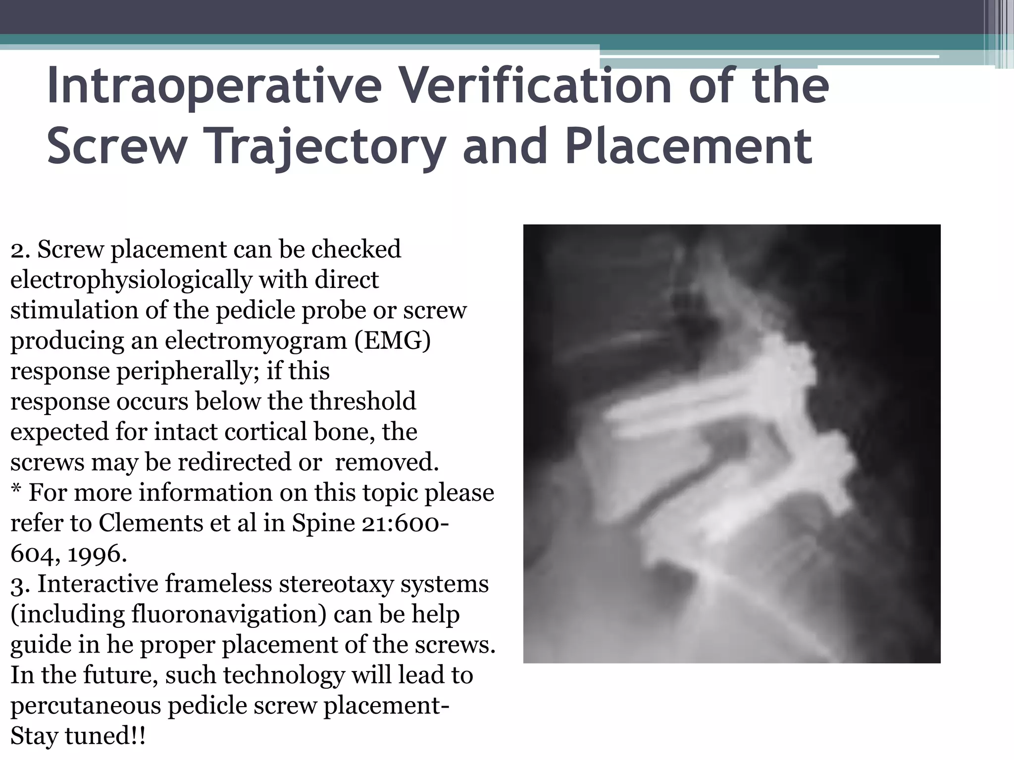Technique transpedincular screw placement | PPTX