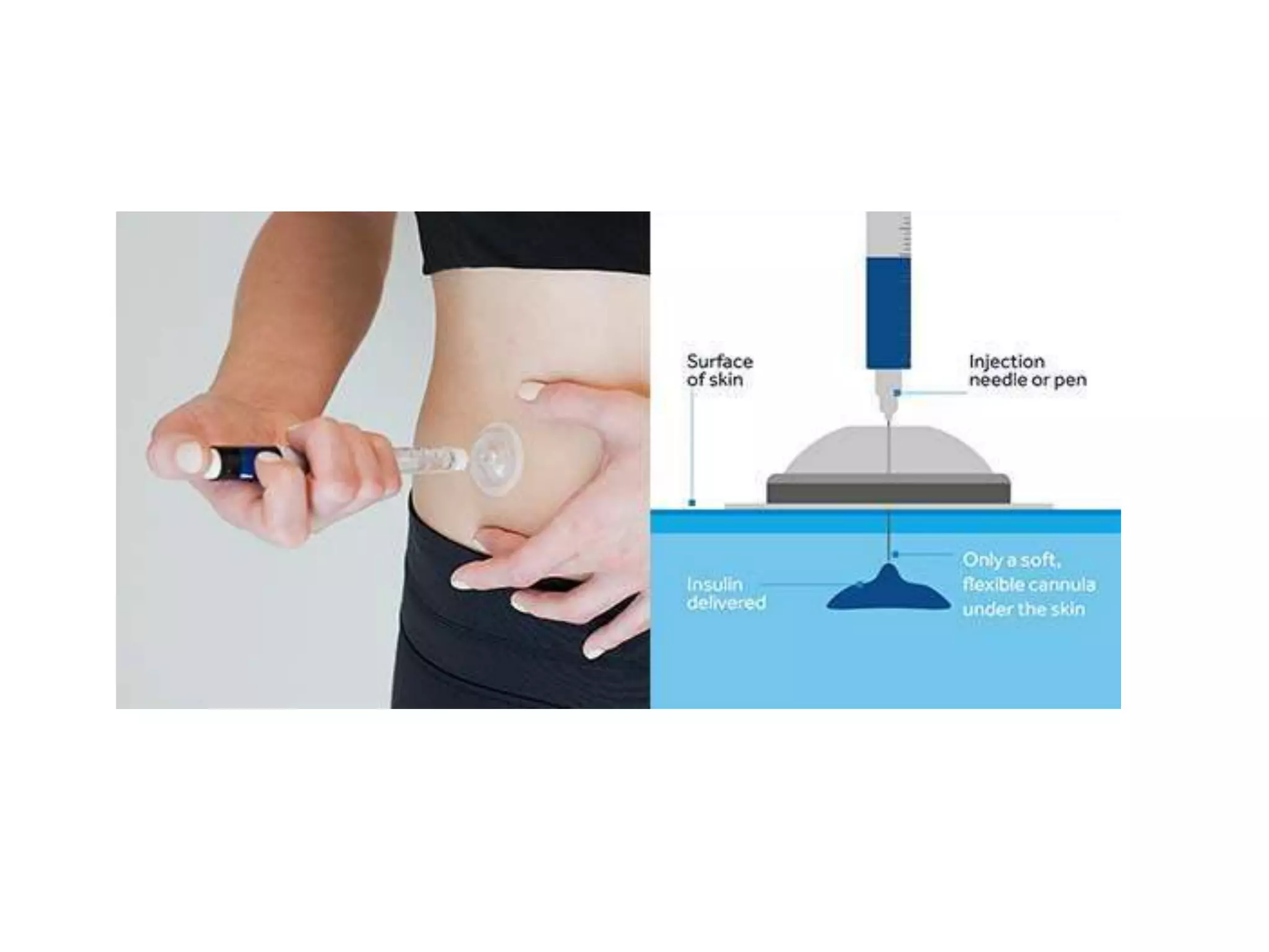 Technology in insulin delivery systems future directions.pptx