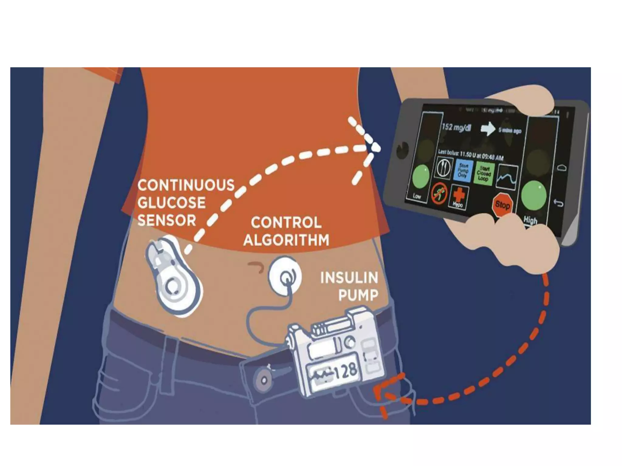 Technology in insulin delivery systems future directions.pptx