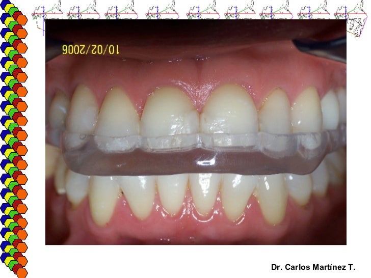 TECNICA DE ENCERADO PARA GUARDA OCLUSAL