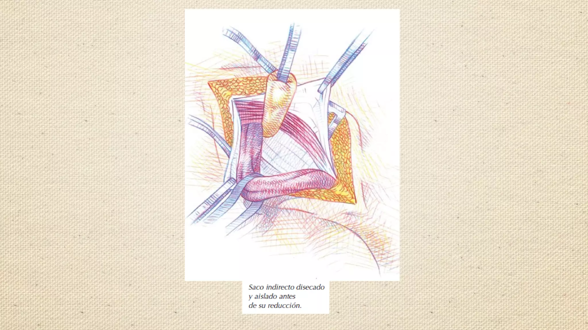 Tecnica Quirúrgica Hernioplastía Inguinal 1 Pdf