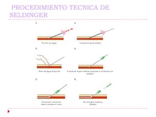 Técnica de colocación de catéter venoso central | PPTX
