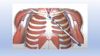 Tecnica de colocacion de tubo de Torax.pptx