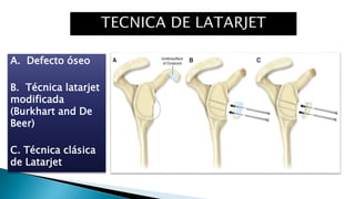 Tecnica de latarjet, inestabilidad de hombro, luxación de hombro | PPTX