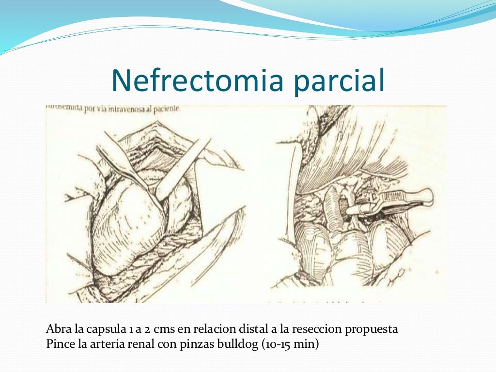 Tecnica de nefrectomia simple y parcial