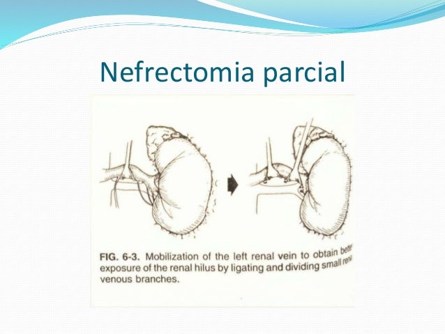 Tecnica de nefrectomia simple y parcial