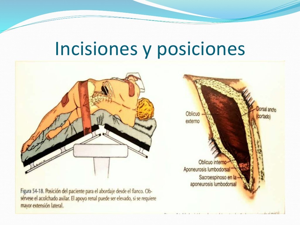 Tecnica de nefrectomia simple y parcial