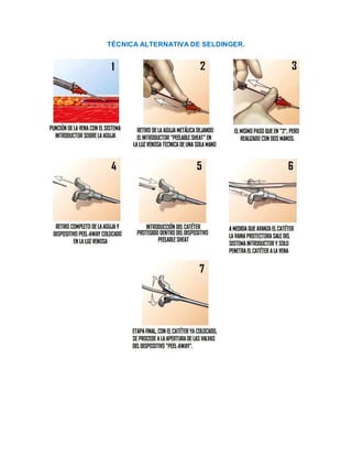 Tecnica de seldinger | DOCX