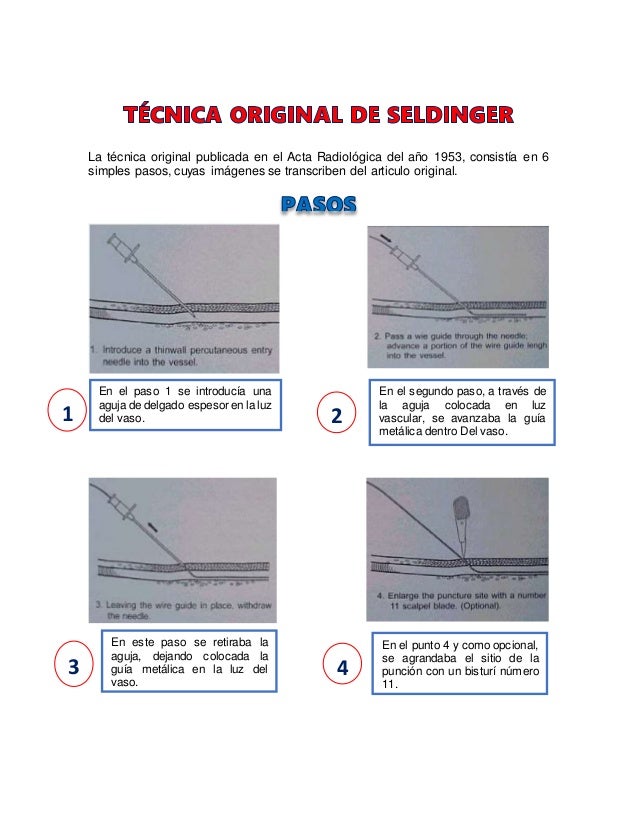 Tecnica de seldinger