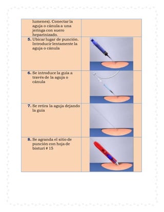 Tecnica de seldinger | DOCX