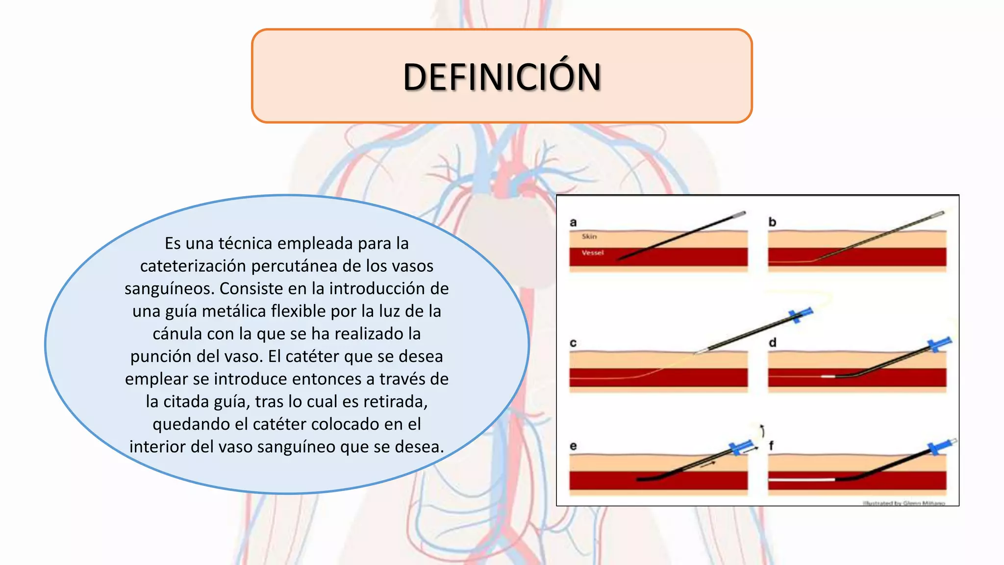 Tecnica de seldinger | PPT