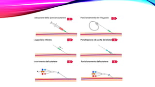 Tecnica de seldinger | PDF