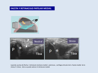 Tecnica eco rodilla | PPTX
