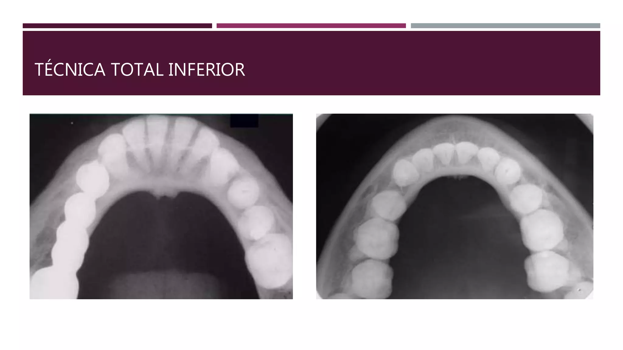 Tecnica radiografica oclusal | PPTX