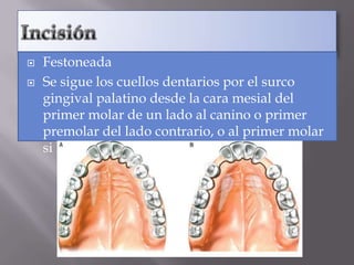 Tecnica quirurgica para caninos retenidos | PPTX