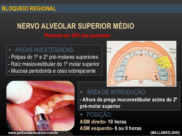 Posterior Superior Alveolar Injection