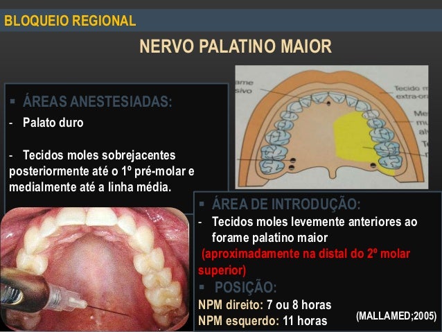 TÉCNICAS ANESTÉSICAS DA MAXILA