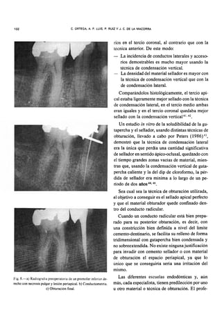 Tecnicas de obturacion_en_endodoncia | PDF