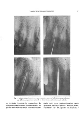 Tecnicas de obturacion_en_endodoncia | PDF
