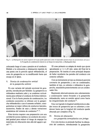 Tecnicas de obturacion_en_endodoncia | PDF