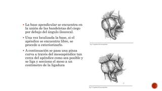 TECNICAS QUIRURGICAS DE APENDICENTOMÍA ABIERTA.pptx