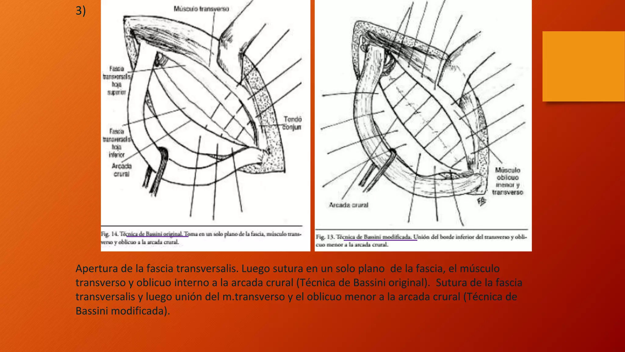 Tecnicas quirurgicas inguinal. Hernia crural..pptx