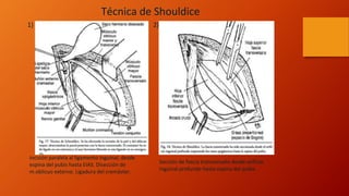 Tecnicas quirurgicas inguinal. Hernia crural..pptx