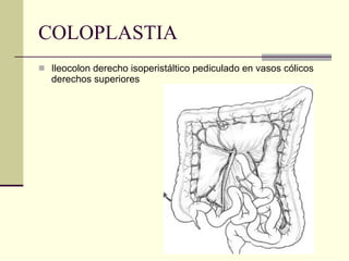 Técnicas quirúrgicas en el cáncer de esófago | PPT