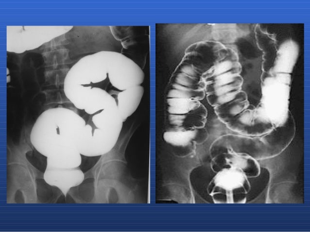 Tecnicas radiológico del colon