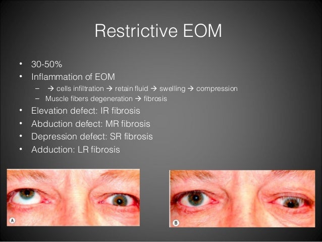 Thyroide Eye Disease