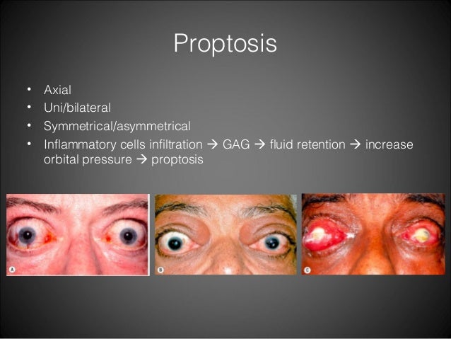 Thyroide Eye Disease