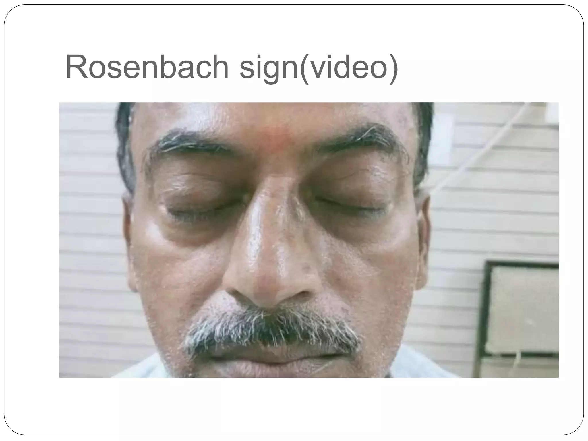 thyroid eye disease | PPTX | Thyroid Disorders | Endocrine and ...