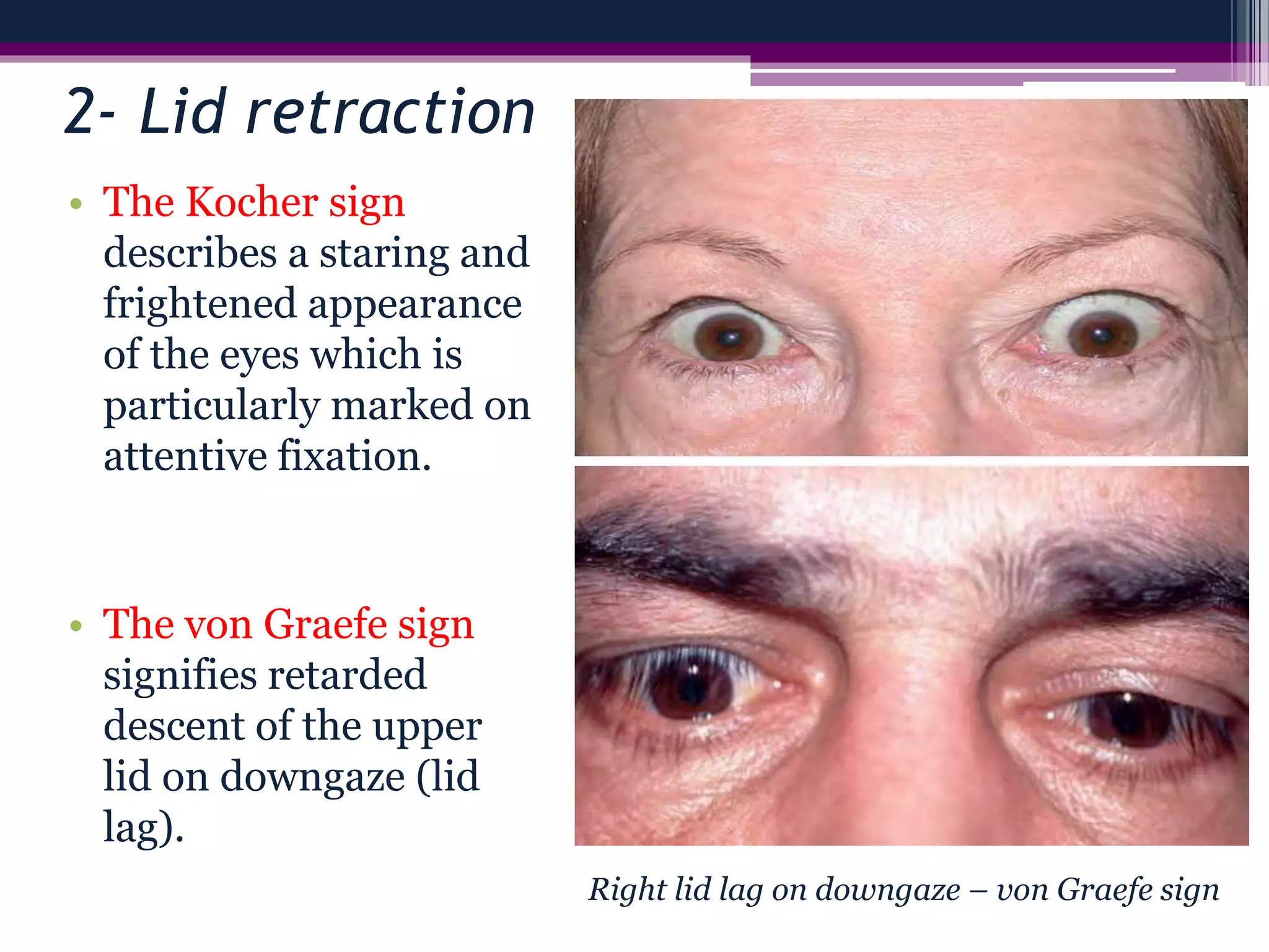 Thyroid eye disease | PPTX