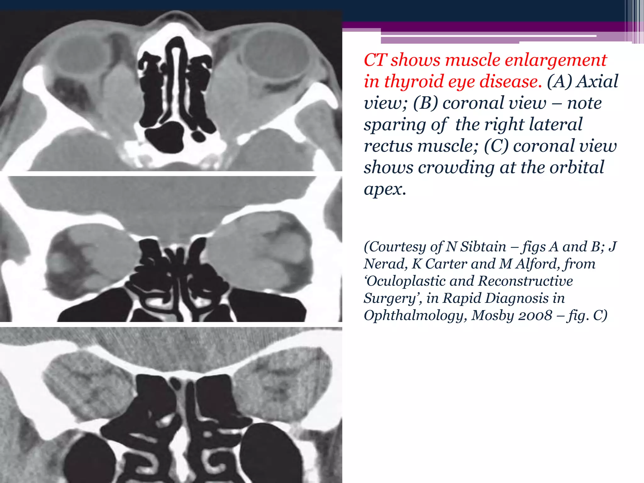 Thyroid eye disease | PPTX