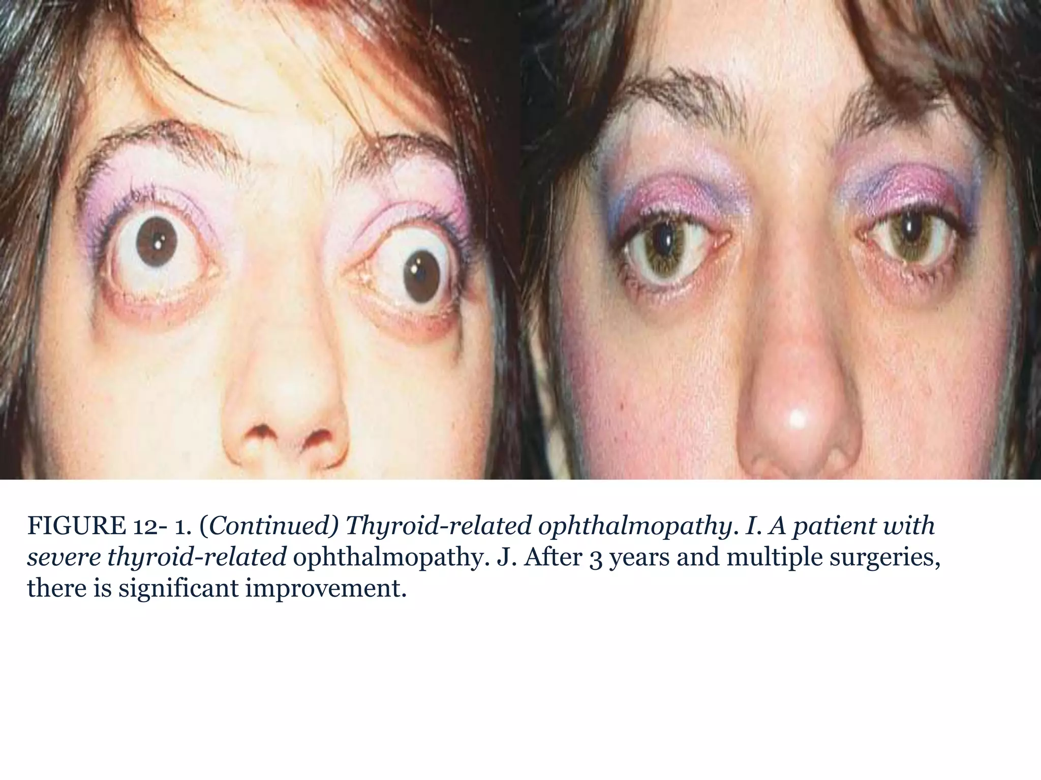 Thyroid eye disease | PPTX