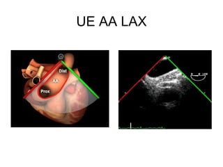 Trans esophageal echocardiography (TEE) orientation | PPT | Heart and ...
