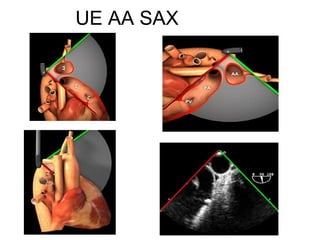 Trans esophageal echocardiography (TEE) orientation | PPT
