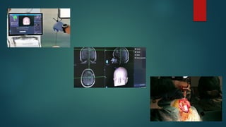 Neuronavigation Software to visualize and surgically approach brain ...
