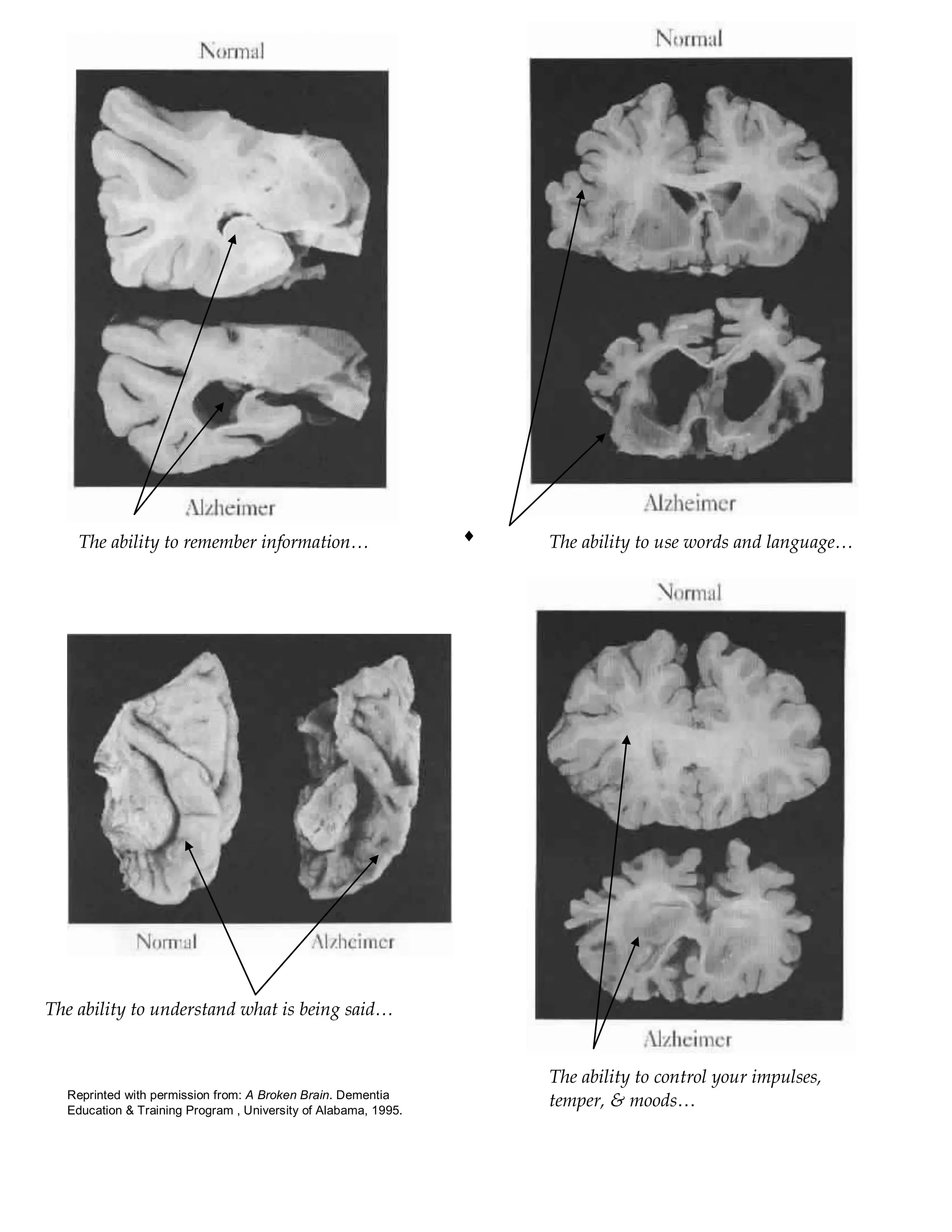 Teepa Snow Dementia Building Skill Handout | PDF