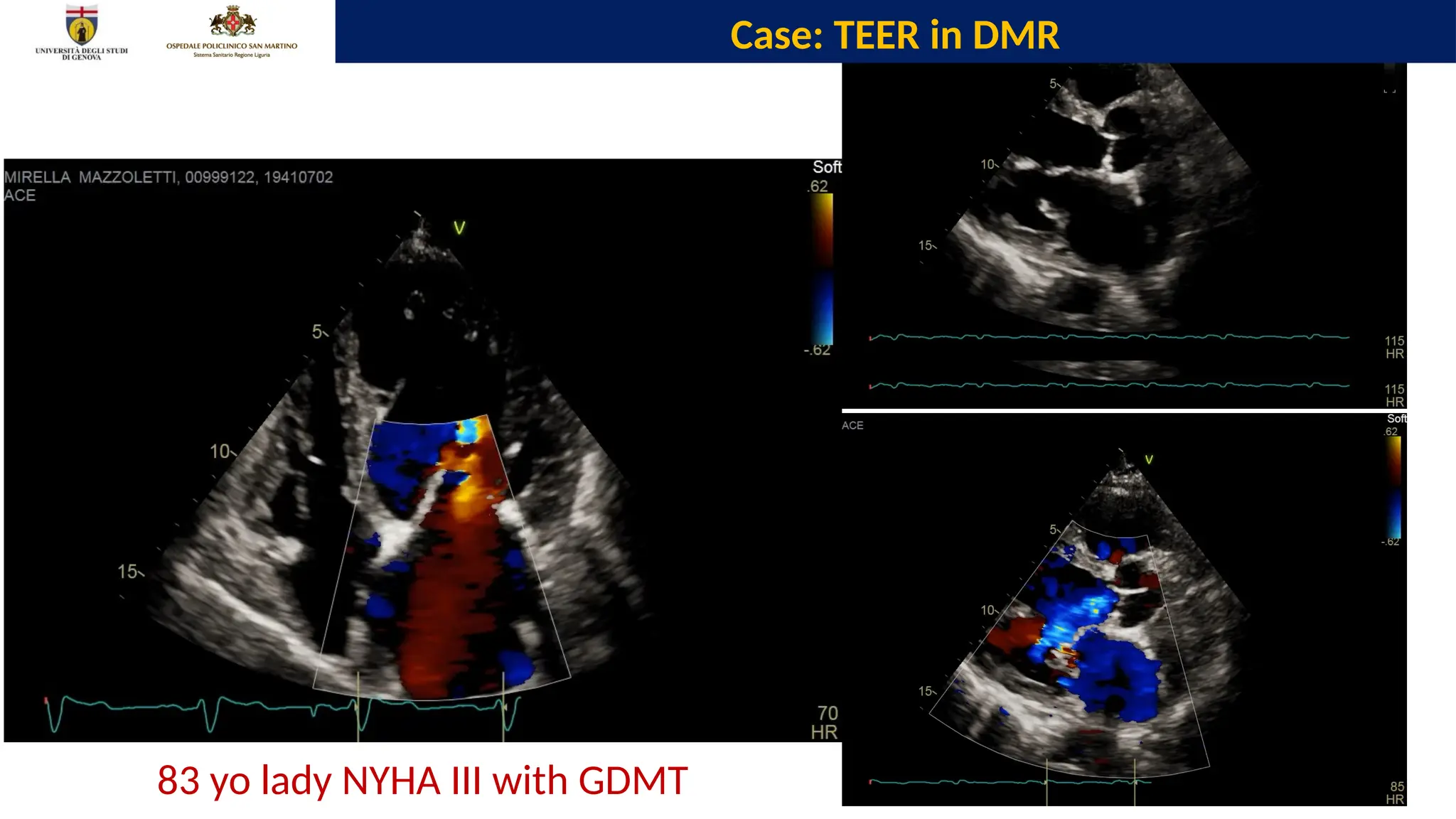 TEER vs. Surgery for mitral regurgitation.pptx