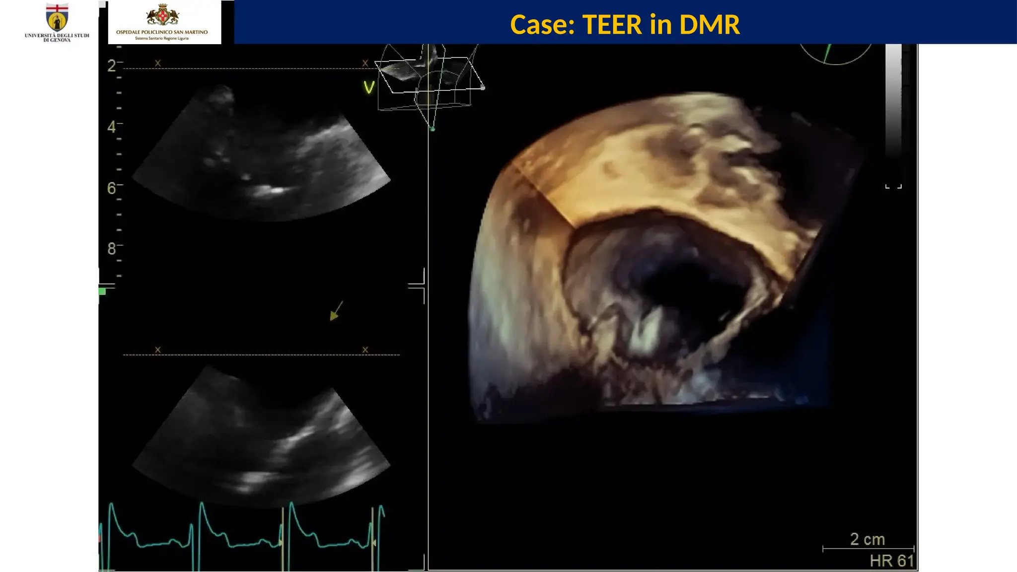 TEER vs. Surgery for mitral regurgitation.pptx