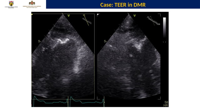 TEER vs. Surgery for mitral regurgitation.pptx