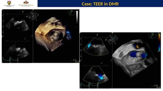 TEER vs. Surgery for mitral regurgitation.pptx