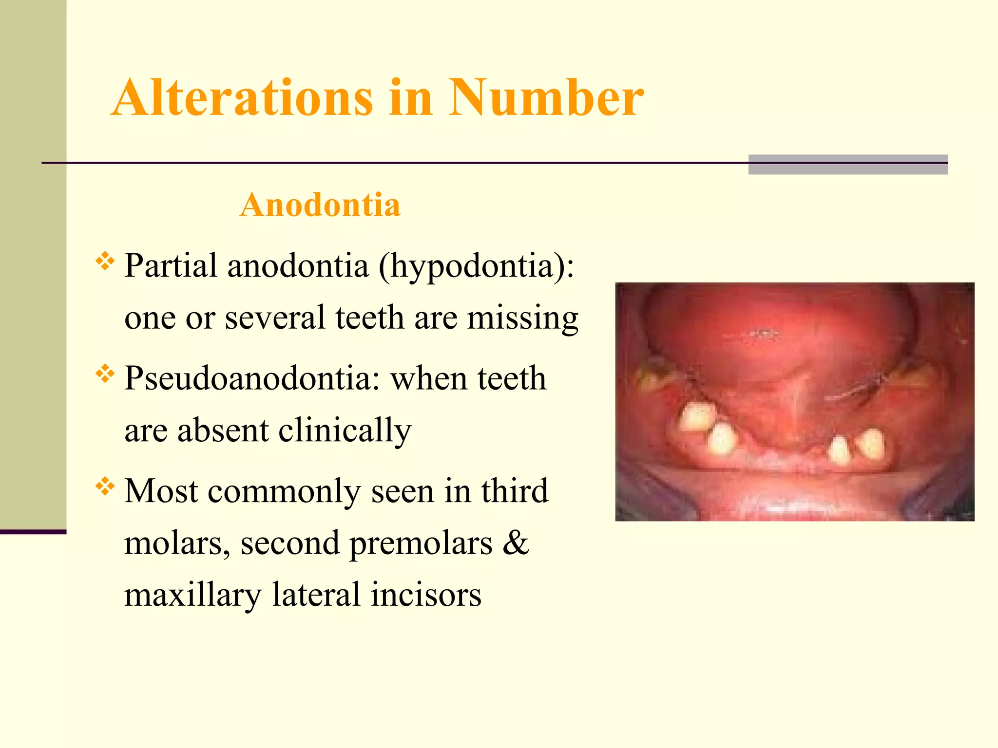 Teeth abnormalities ii | PPT