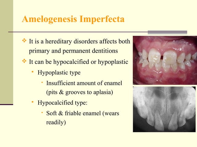 Teeth abnormalities ii | PPT
