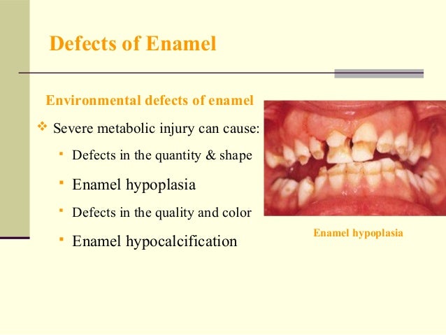Teeth abnormalities ii
