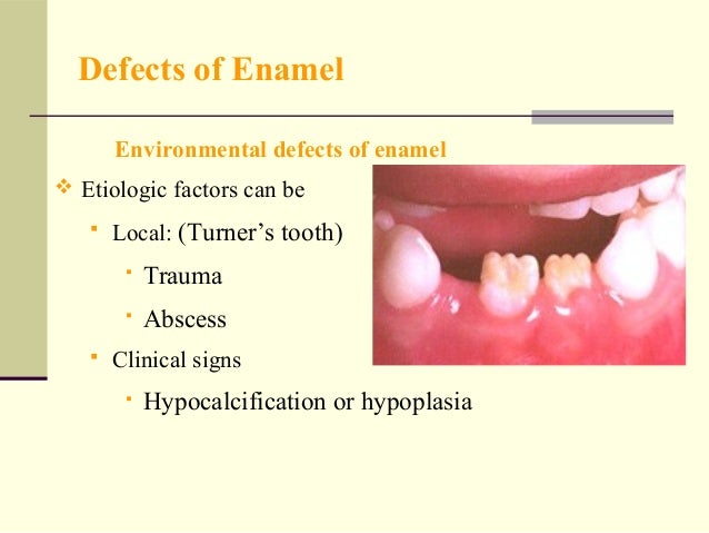 Teeth abnormalities ii